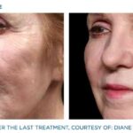 Skin Tightening, Fat Reduction | Exion | The Glenmore Clinic