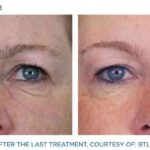 Skin Tightening, Fat Reduction | Exion | The Glenmore Clinic