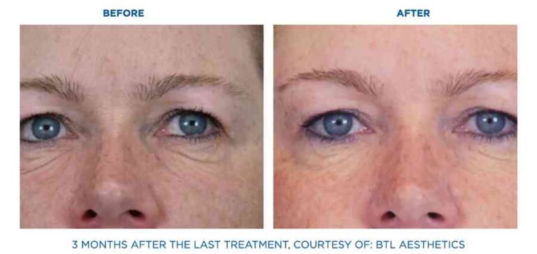 Skin Tightening, Fat Reduction | Exion | The Glenmore Clinic