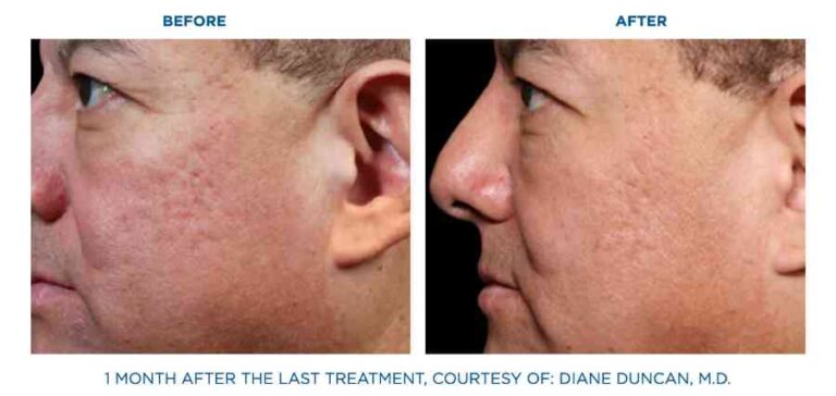 Skin Tightening, Fat Reduction | Exion | The Glenmore Clinic