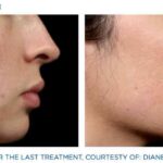 Skin Tightening, Fat Reduction | Exion | The Glenmore Clinic